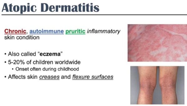 Effective Atopic Dermatitis Treatment And Diagnosis